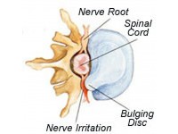 Back Pain? It's Probably Not Your Herniated Discs | Long Beach, NY Patch