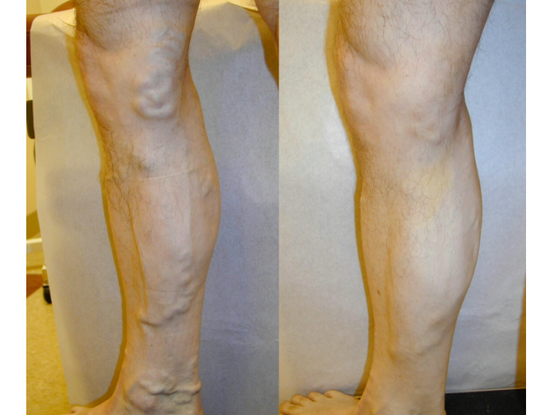 DR. COHEN WITH CLEAR VEIN CENTER NOW OFFERING A NON-SURGICAL TREATMENT ...