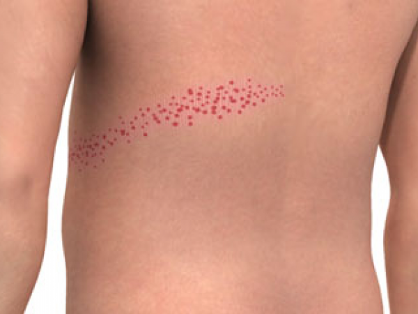The Painful Reality of Shingles - Burr Ridge, IL Patch