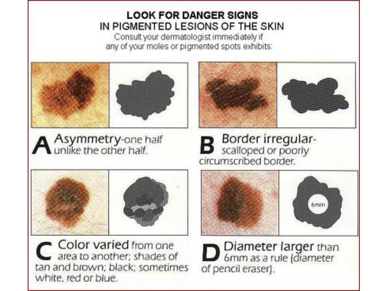 Mole Check: Know Your ABCD's | Upper Dublin, PA Patch